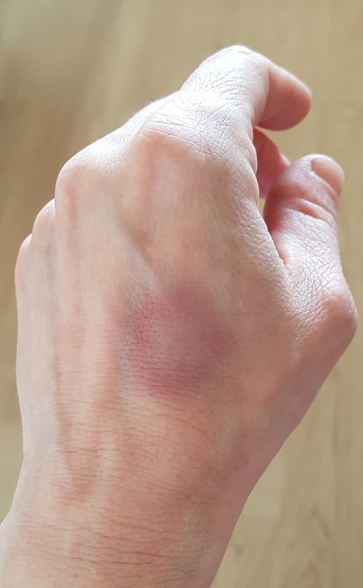 Tekenbeet bij kinderen - een uitleg over de teek