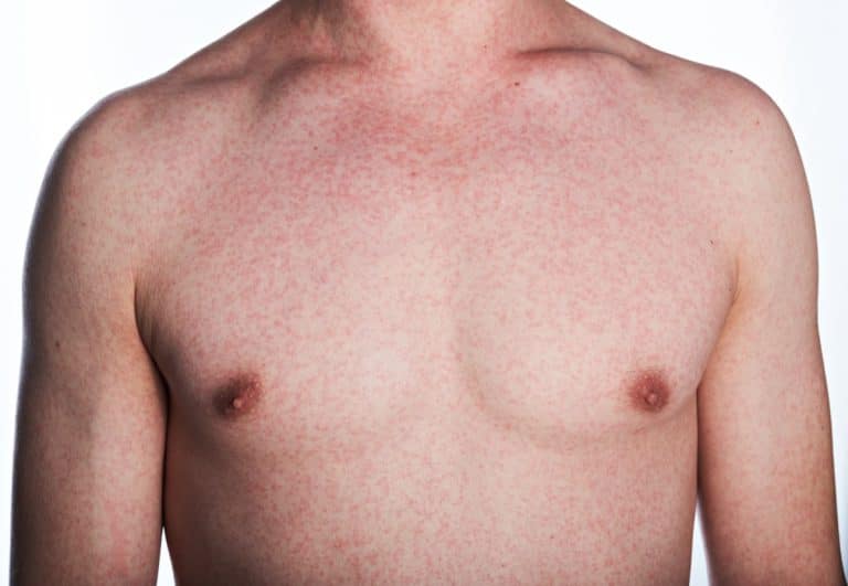 huidschimmel - een lijst met soorten, symptomen en tips schimmels