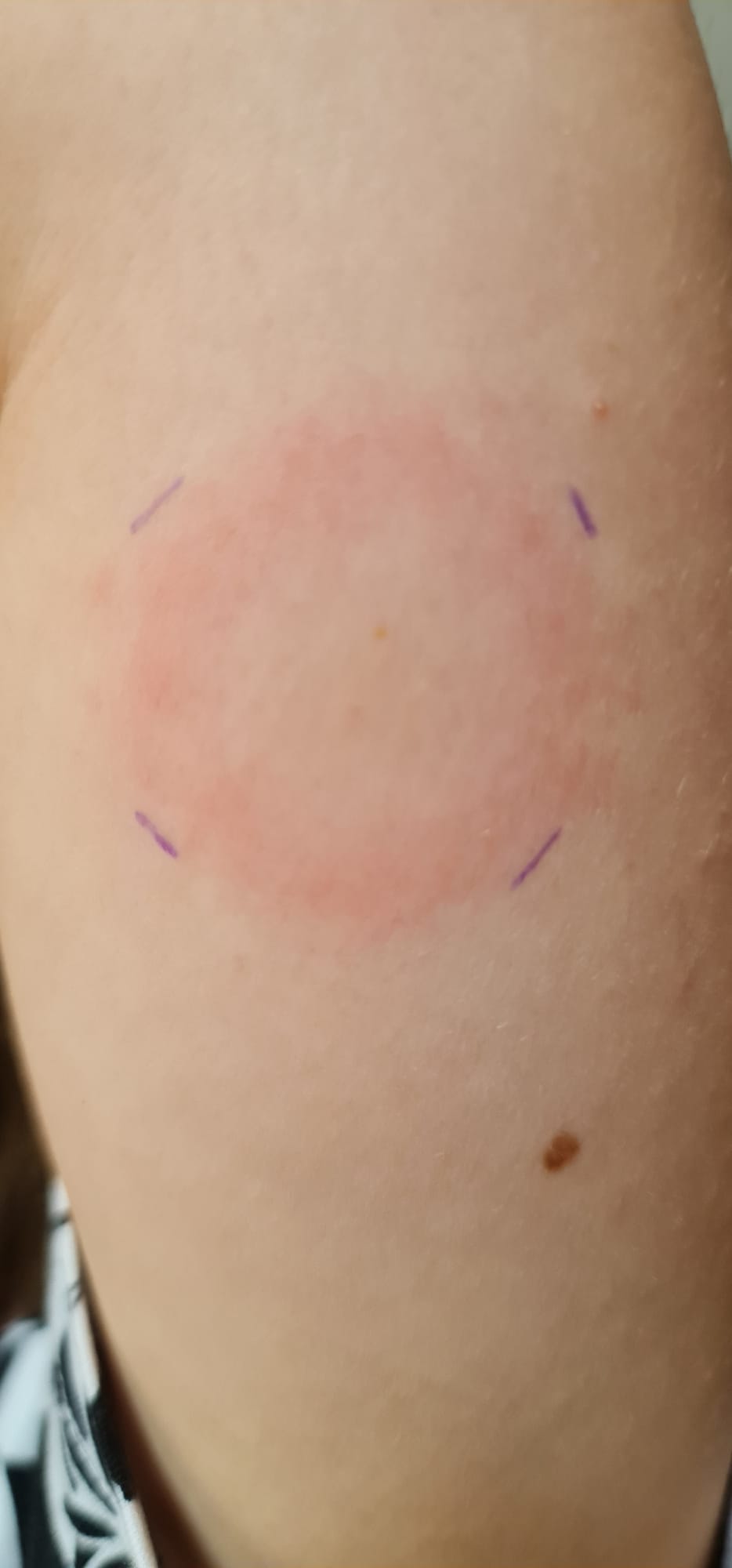 Tekenbeet kind symptomen - een uitleg in tekenseizoen - MamaScrapelle