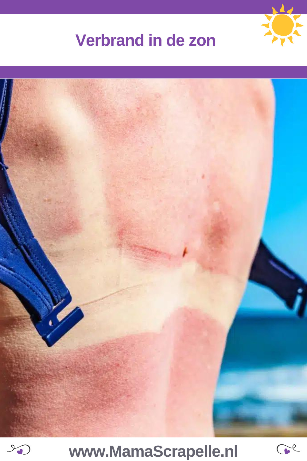 Verbrand in de zon, wat nu? Tips voor ouders en kinderen - MamaScrapelle